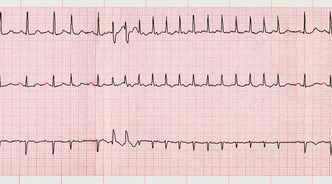O que precisa de saber sobre a arritmia cardíaca - Cardio 365º