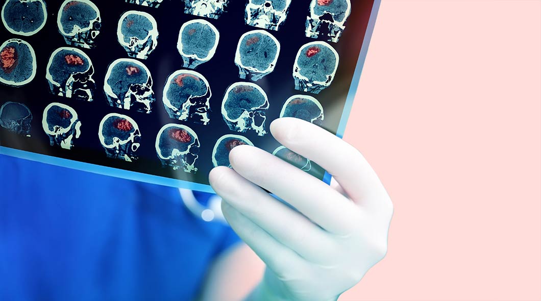 Conheça quais os diferentes tipos de AVC - Cardio 365º