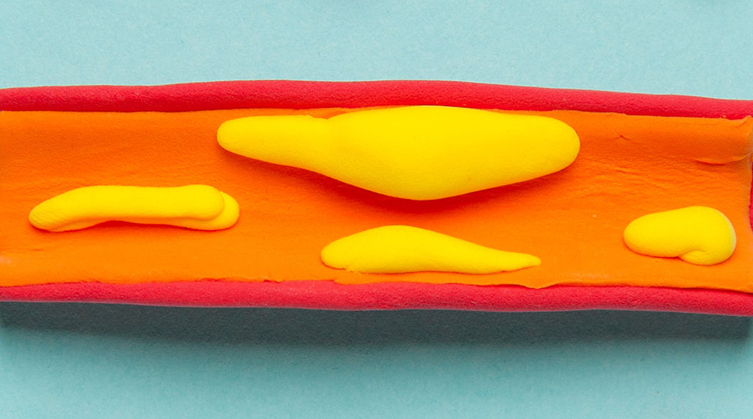 Como se forma a placa de ateroma? - Cardio 365º